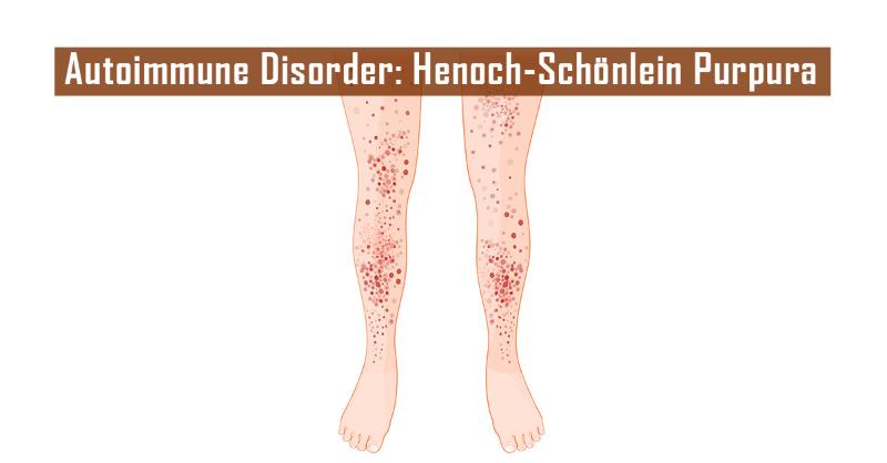 Henoch-Schönlein Purpura: IgA Mediated Disorder | MedSynapse