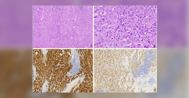 Diagnosis of Pollakiuria and Nocturia In An Elderly Man | MedSynapse
