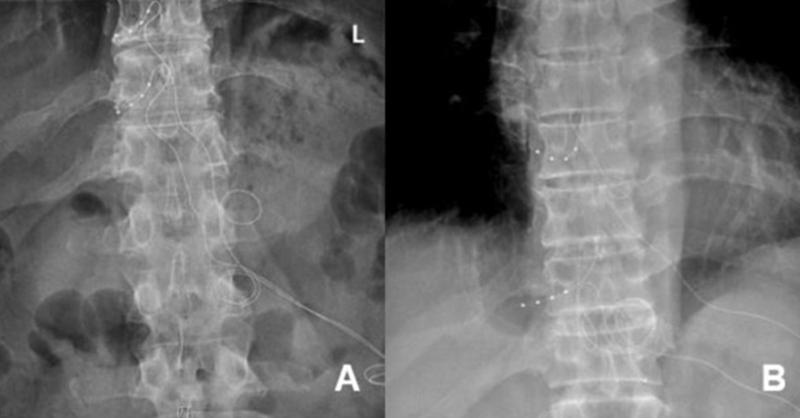 Thoracic Ganglionectomy: A Rescue Technique for Failed Dorsal Root ...