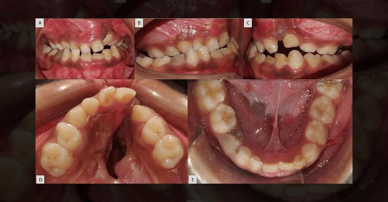 Pediatric Patient with Cleft Lip, Palate, and Mid-Face Retrusion ...