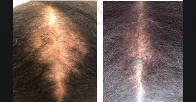 Enlarging Alopecic Patch in an Elderly Female with Central Centrifugal ...