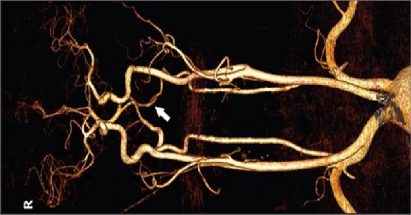 An Isolated Vertigo Incident in a Young Male Causes ED visit ...