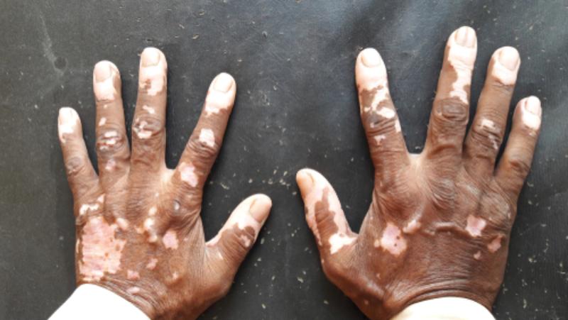 Potent Line of Treatment for Vitiligo acral? | MedSynapse