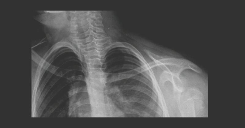 Shoulder Fracture-Dislocation In A 7-Year-Old Child: A Case Report ...