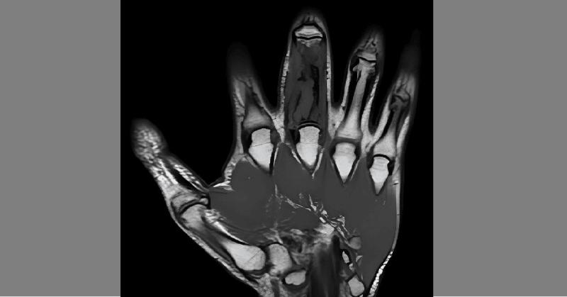 Diagnosis of Long-Term Pain and Enlargement in the Proximal Phalanx ...