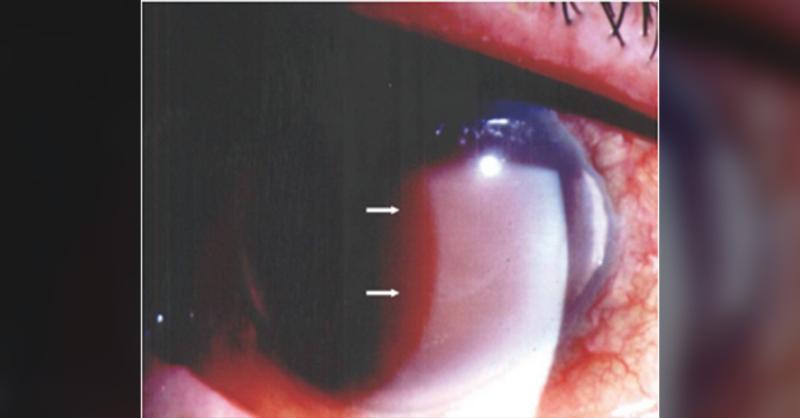 A Five-Decade Retinal Detached Eye with an Acute Onset of Redness and ...
