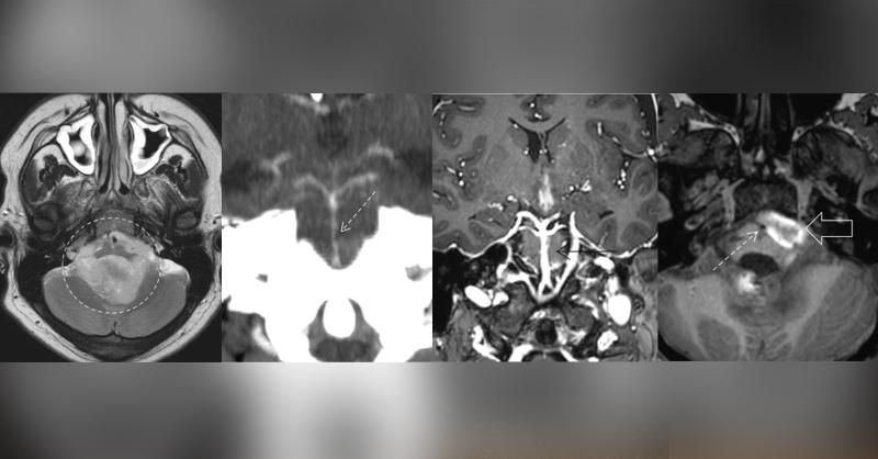 Management of Basilar Artery Surgery after Operative Cerebellar Mutism ...