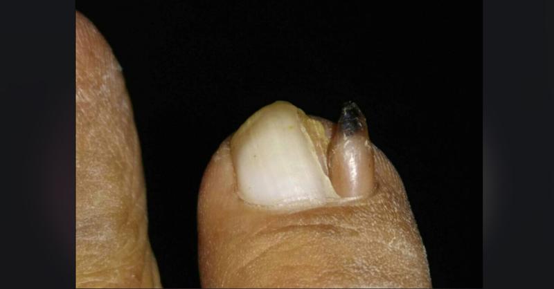 Identify Unfamiliar Toenail Condition in Patient | MedSynapse