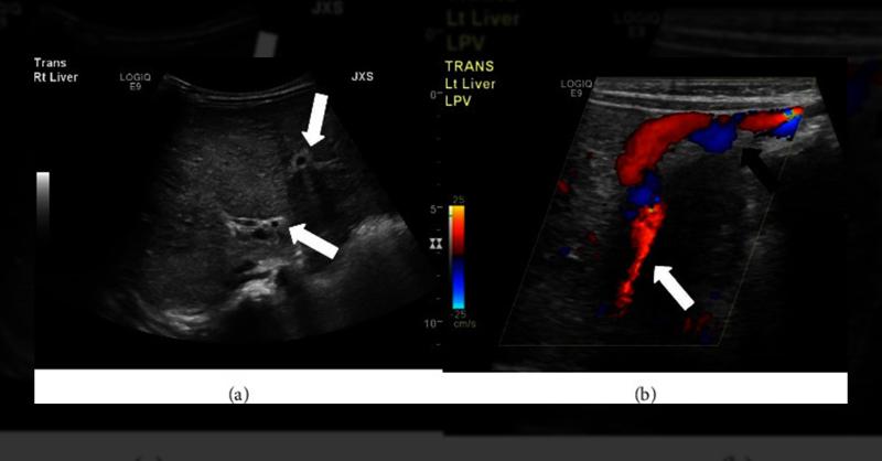Pediatric Hepatic Fibrosis in Child without any Causative Factors ...