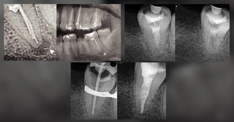 Orthograde Retrieval of Extruded Instrument following Periapical Tissue ...
