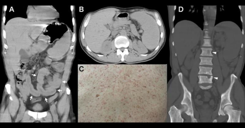 Acute Abdomen due to Anaphylactic Intestinal Edema associated with ...