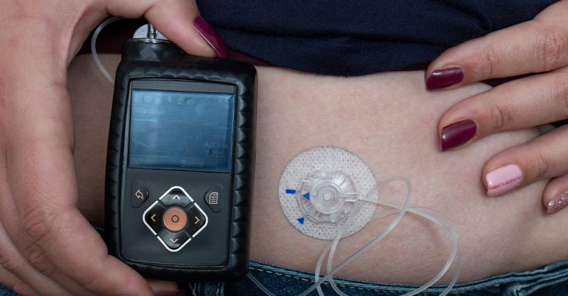 Rare Complication after Initiation of Hybrid Closed-loop Insulin Pump ...