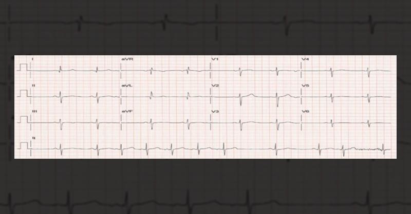 A Case Of Exercise Induced Atrial Fibrillation In 54 Year Old Athletes Medsynapse