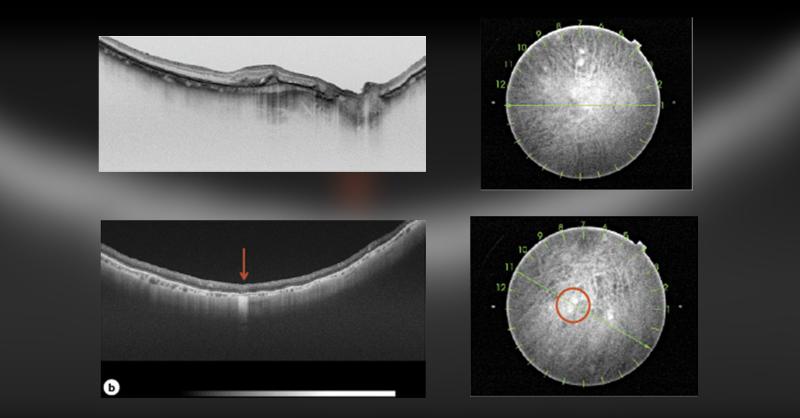 What Induced Progressive Retinal Necrosis in the Contralateral Eye of ...