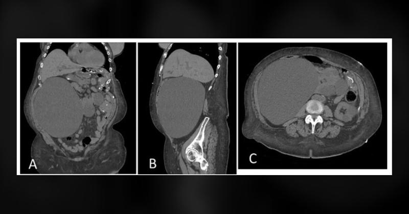 Worsening Flank Pain and Hyperkalemia In Woman | MedSynapse