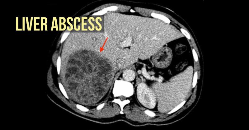 Learn More on Diagnosis and Management of Liver Abscess | MedSynapse
