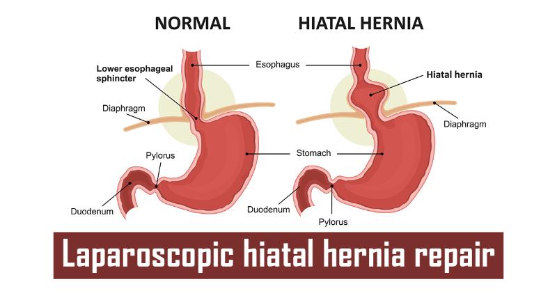 Laparoscopic hiatal hernia repair using sutures versus sutures reinforced with non-absorbable ...