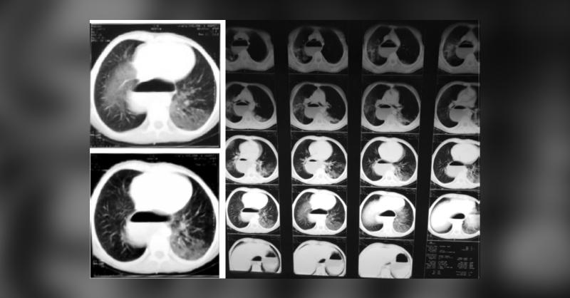 Recurrent pneumonia and bronchitis in a 12-year-old Girl with ...