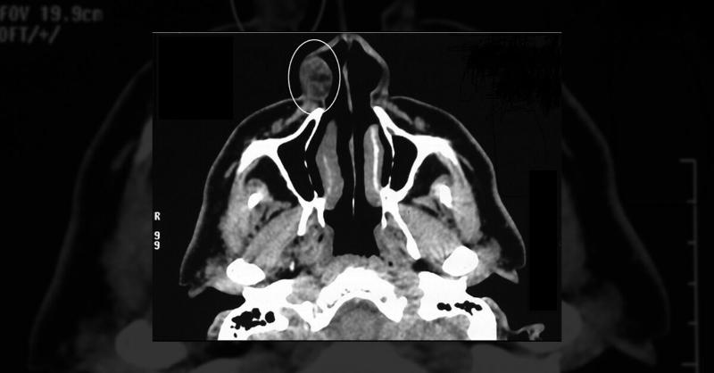 Diagnosis of Recurrent Epistaxis and Nasal Obstruction | MedSynapse