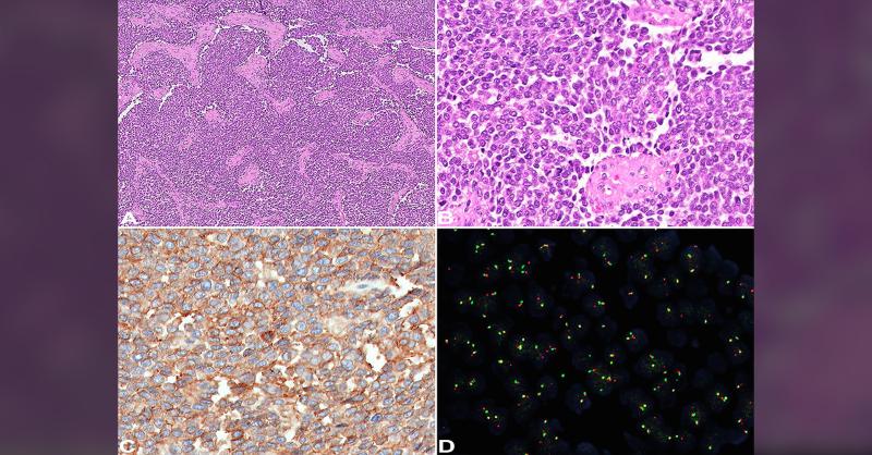 A Patient with Suspected Renal Carcinoma Showed Irregularly Lobulated ...