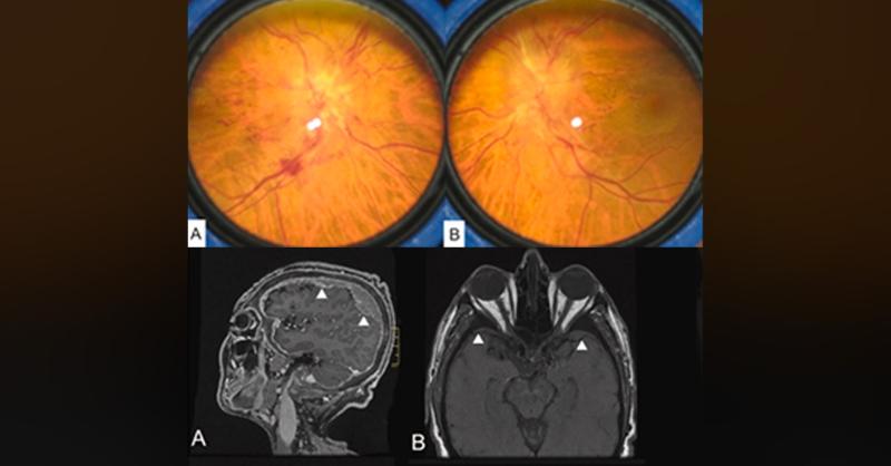 A Rare Case of Advanced Disseminated Prostate Cancer with Bilateral ...