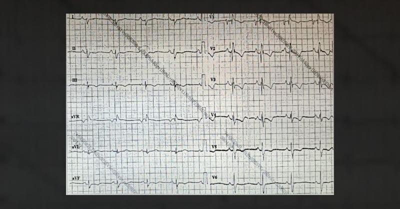 Isolated Right Ventricular Non-Compaction in a Young Man | MedSynapse