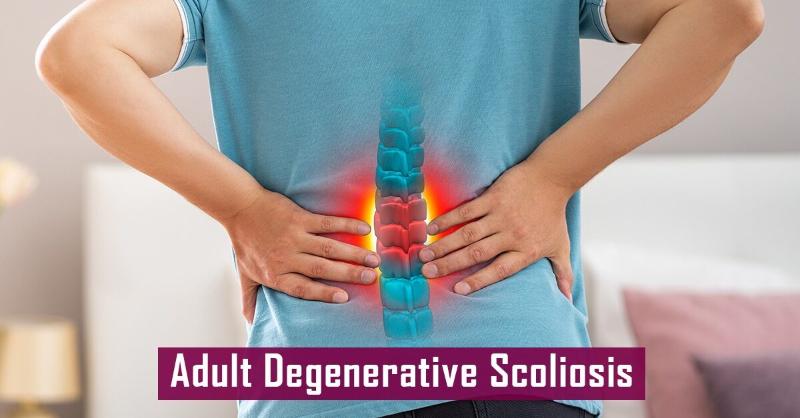 Managing Causes and Complications of Adult Degenerative Scoliosis ...