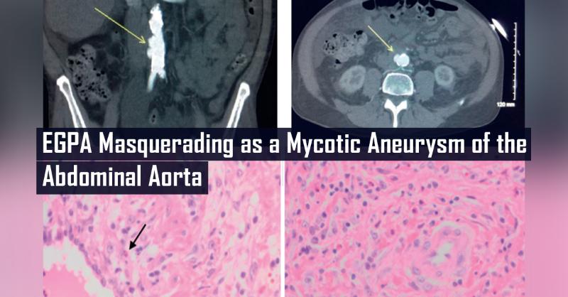 Eosinophilic Granulomatosis Polyangiitis (EGPA) Masquerading as a ...