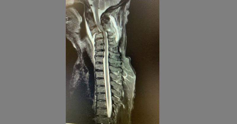 Patient Presents with Transient Quadriplegia 30 minutes after Actual ...