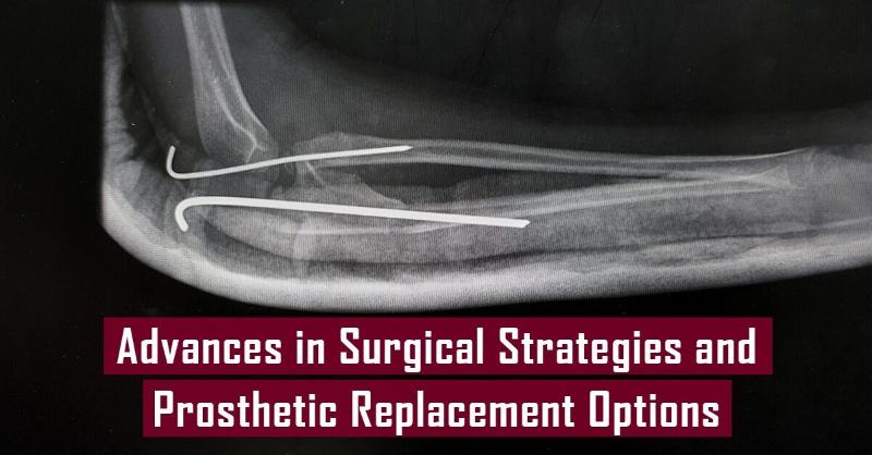 Excision Versus Prosthetic Replacement- Which One is a Better Surgical ...