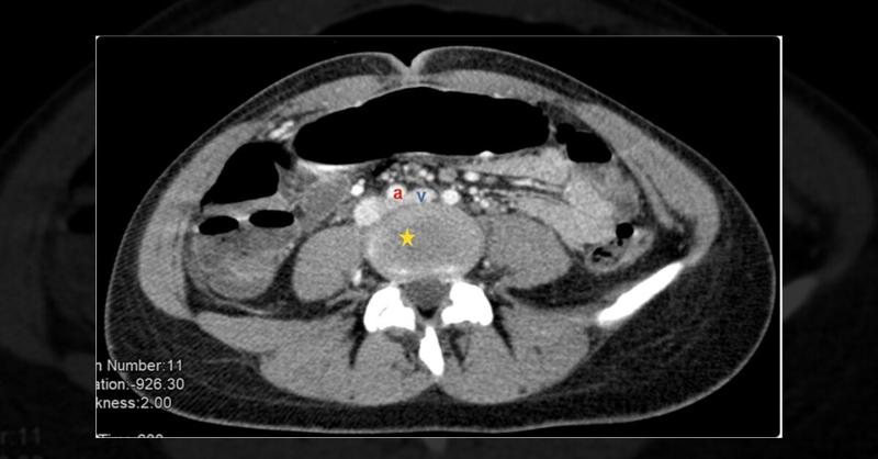 Effective Treatment Strategies for Patients with Failed Endovascular ...