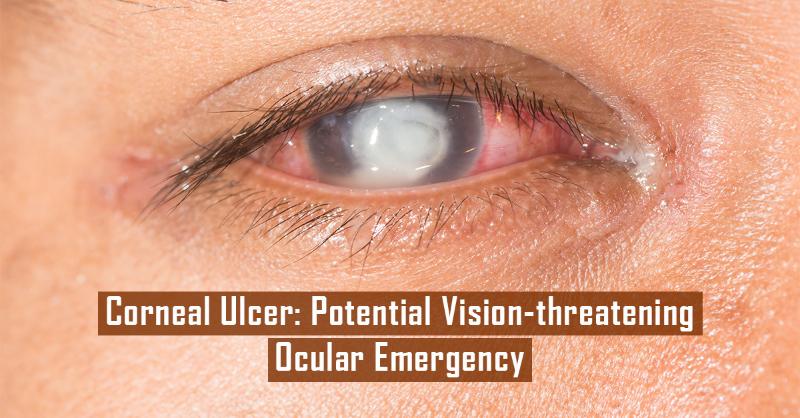 Corneal Ulcer an Open Sore on the Cornea its Treatment, and Management ...