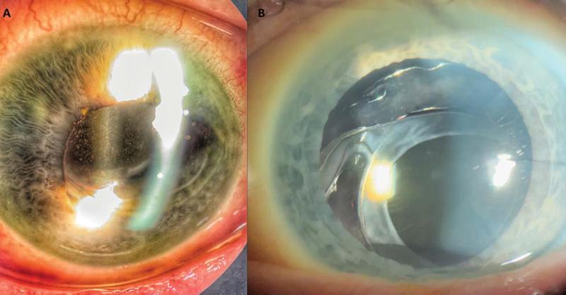 IoL Punch and Rescue: A Novel Technique for Fixing Dislocated Single ...