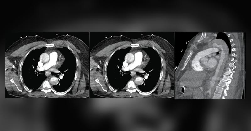 A Case of Atypical Presentation of Iatrogenic Aortic Dissection ...