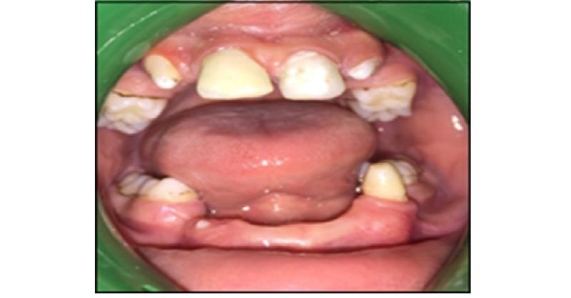 Delayed Eruption of Permanent Dentition and Malaise…Diagnose Unusual ...