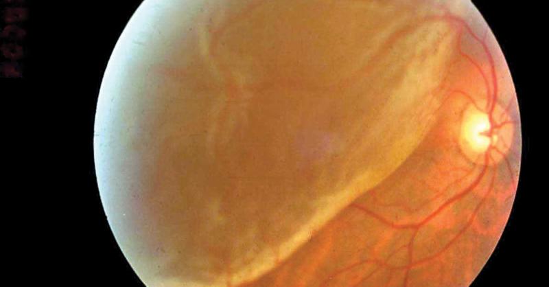 Diagnosis and Management of Retinal Detachment | MedSynapse