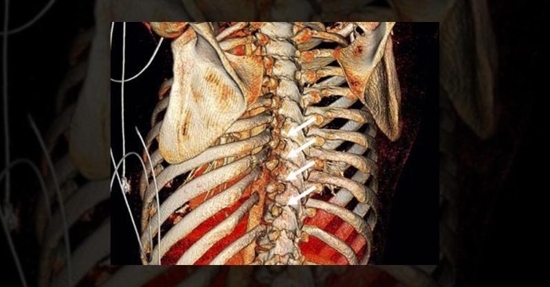 Radiological Examination of Vertebral Injury | MedSynapse