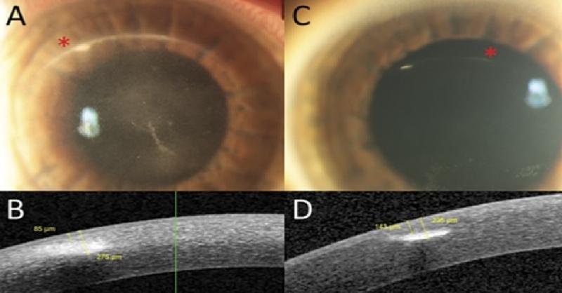 Management of Rare Sterile infiltrates After Corneal Crosslinking ...