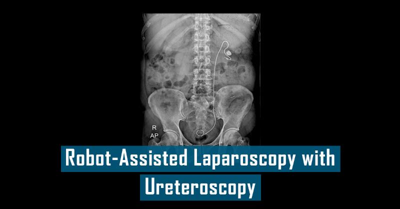 Is the Combination of Robot-Assisted Laparoscopy and Ureteroscopy an Effective Method for ...
