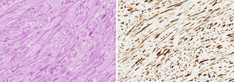 A Rare Case of Bladdser Inflammatory Myofibroblastic Tumor | MedSynapse