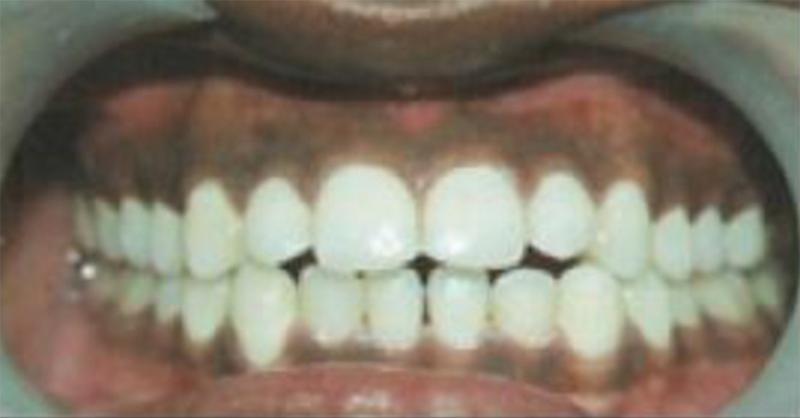 Gingival Depigmentation in a 22 year old Female | MedSynapse