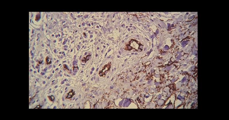 Diagnosis of Pruritic Skin Lesions Associated with Ulcerative Colitis ...