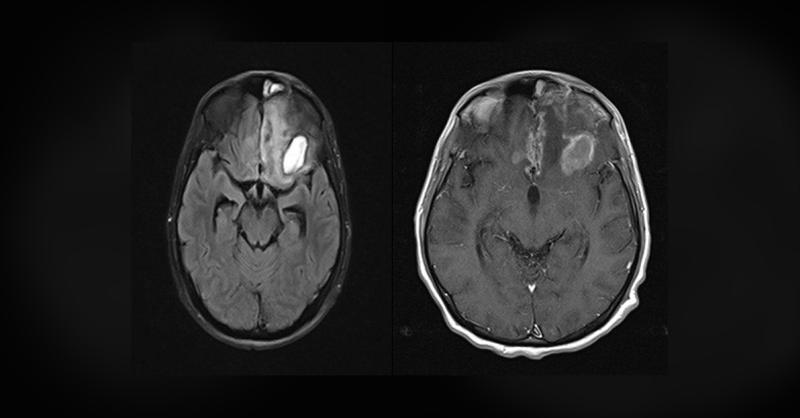 A Rare Case of Brain Abscesses in Diabetes Mellitus Patient | MedSynapse