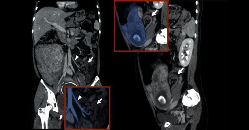 Primiparous Woman Presents with Lower Abdominal Pain | MedSynapse