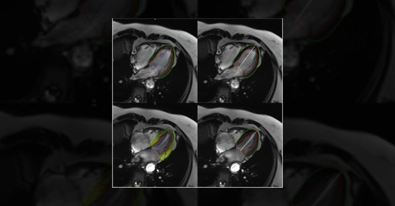 Reproducibility Assessment of Rapid Strains in Cardiac MRI: Insights ...