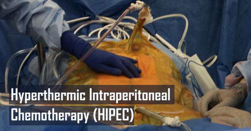Overview of Hyperthermic Intraperitoneal Chemotherapy | MedSynapse
