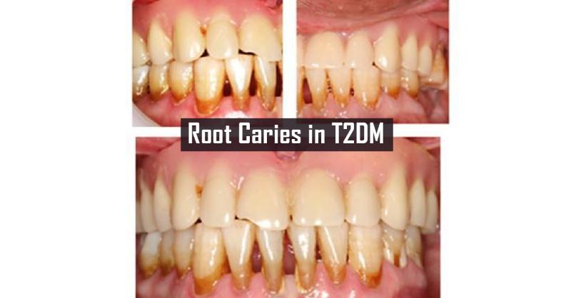 Management of Dental Caries in Type 2 Diabetes Patients | MedSynapse