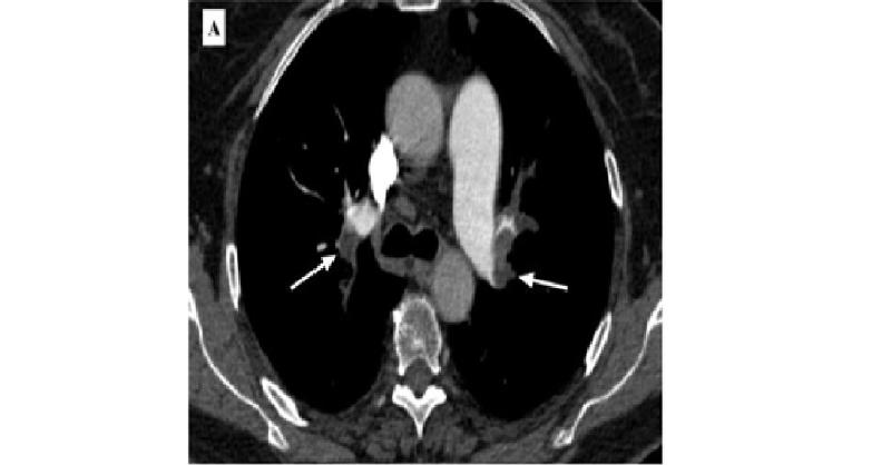 CT Angiogram Showing Pulmonary Artery Filling Defects In An Elderly ...