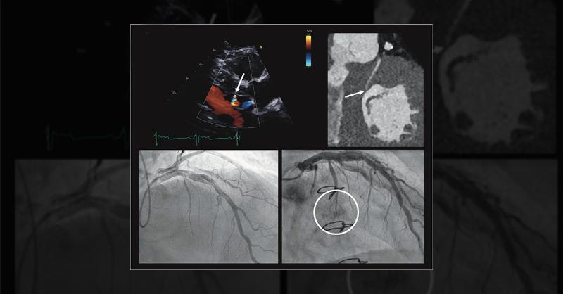 Managing Presyncope in Hypertrophic Obstructive Cardiomyopathy | MedSynapse