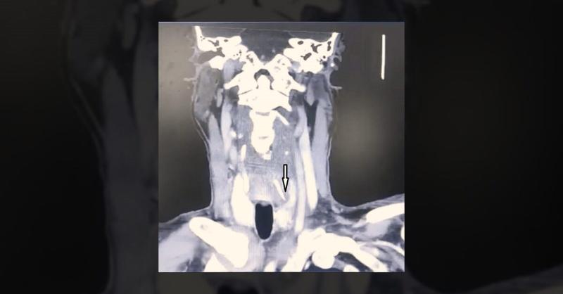 Management of Fish Bone Ingestion in a 71-Year-Old Gentleman | MedSynapse
